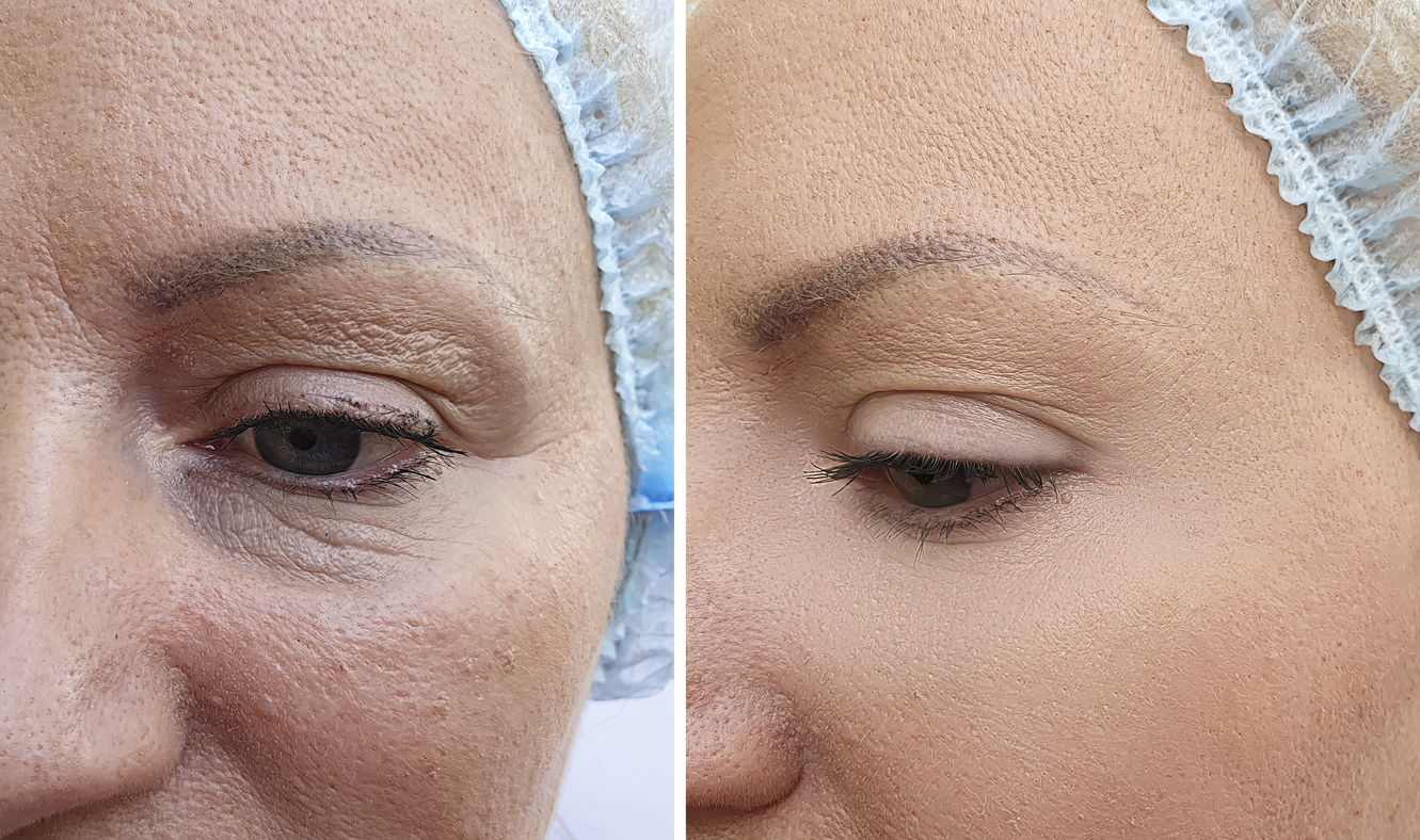 11 عکس مزوتراپی دور چشم و زیر چشم [قبل و بعد]